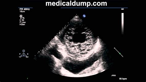 Noncompaction Of Left Ventricle Transthoracic Echocardiogram Tte