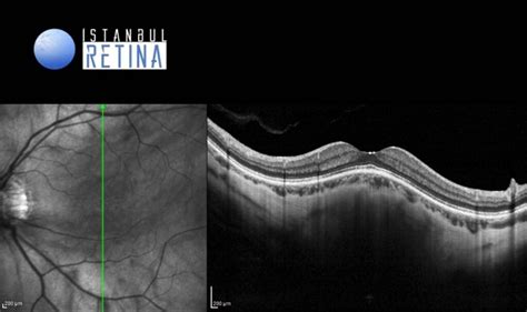 Serous Retinal Detachment Oct