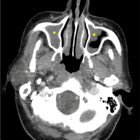 Maxillary Computed Tomography Ct Scan Showing Acute Inflammatory Download Scientific Diagram