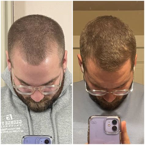 659 Best Finasteride Images On Pholder Tressless Transtimelines And