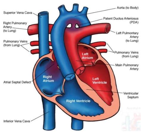 Transposition Of Great Arteries Intechopen