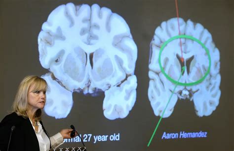 Heres What To Know About Cte The Brain Disease The Nyc Shooter Blamed