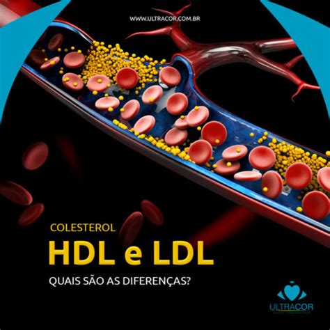 Colesterol Hdl E Ldl Quais São As Diferenças Ultracor