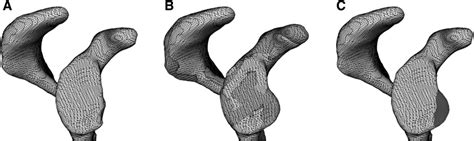 Identification Of Glenoid Bone Defects A Three Dimensional Surface Download Scientific Diagram