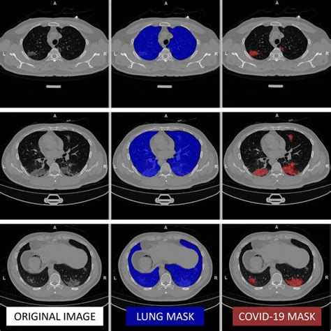 Visual Assessment Of The Lung Segmentations Made With Lungquant V1 And