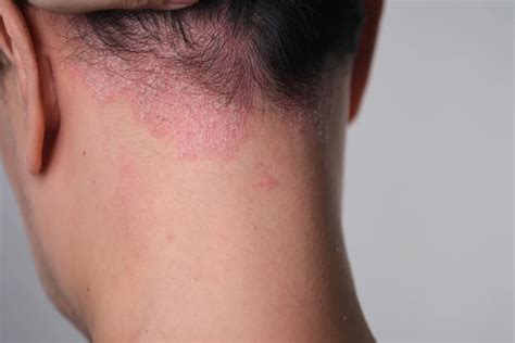 Scabies Rash