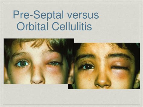 Orbital Cellulitis Vs Periorbital Cellulitis