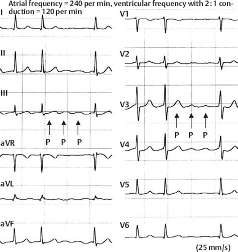 “atypical” Atrial Flutter Thoracic Key
