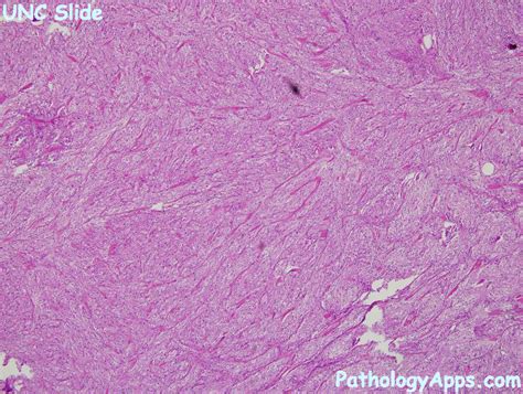 Granular Cell Tumor Pathology