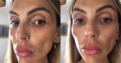 Sarah Nile E Il Suo Viso Provato Dalle Cure Ormonali Il Messaggio Dell