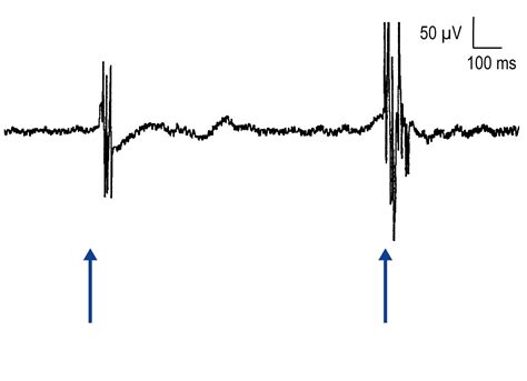 Basic Electromyography Analysis Of Spontaneous Activity Clinical Tree