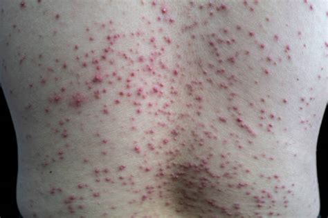 480 Folikulitis Foto Stok Potret And Gambar Bebas Royalti Istock