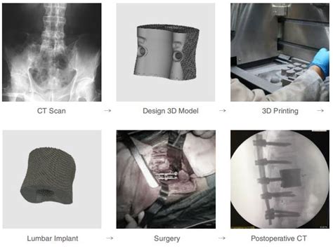 Direct 3d Printed Titanium Alloy Spinal Implants Eplus3d