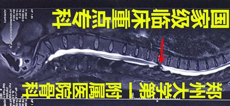 极重度的胸椎管狭窄手术成功 微医挂号网