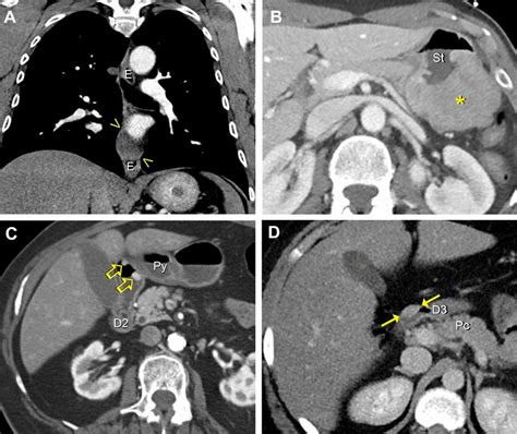 Examples Of Gist Imaging Mimics Aesophageal Leiomyoma—coronal Cect Of Examples Of Gist Imaging Mimics Aesophageal Leiomyoma—coronal Cect Of