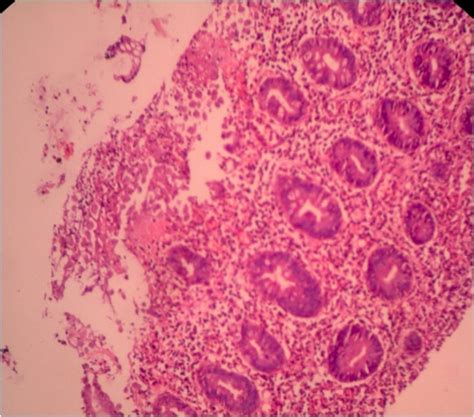 Pathology Outlines Amebic