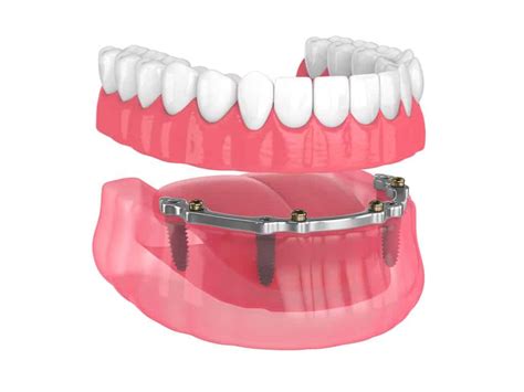 Implant Overdenture 4 2mm Pdf Implant Supported Overdenture