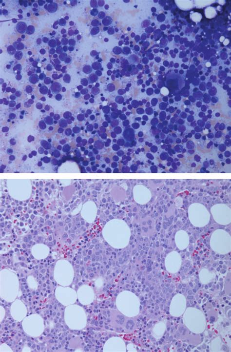 Figure Photographs Of Bone Marrow Aspirate Top And Download