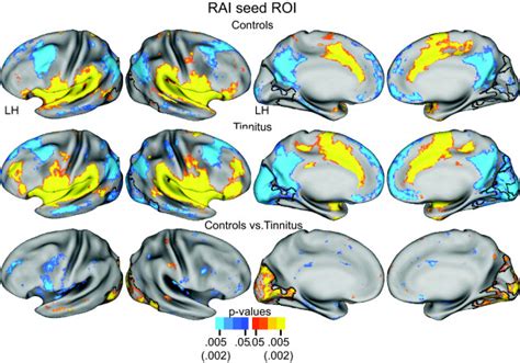 Functional Connectivity Maps For A Seed Region In Right Anterior Insula Download Scientific