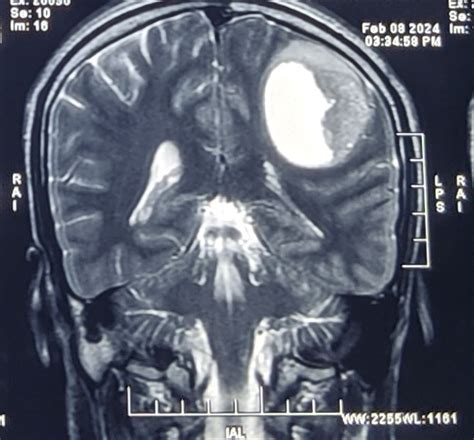 Case Series Of Intracranial Central Primitive Neuroectodermal Tumor In Two Adults Treated With