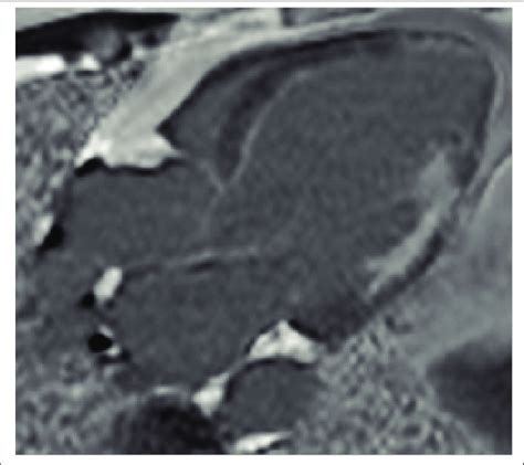 Mri Psir Sequence Postgadolinium Shows 25 To 50 Delayed Enhancement Download Scientific