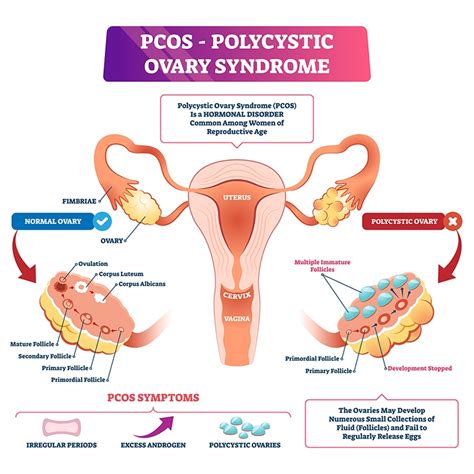 The Flowchart Pathophysiology Of Polycystic Ovary Syndrome Pcos
