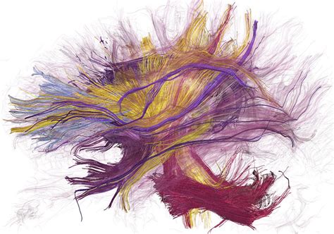 Three Dimensional Dti Visualization In 3d Slicer Tractography Seed