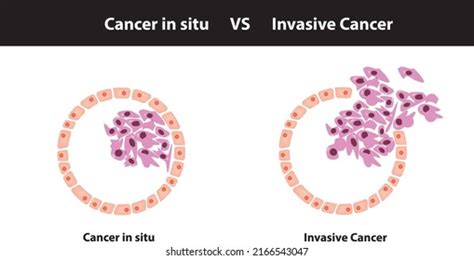 Cancer Situ Vs Invasive Cancer Cells Stock Vector Royalty Free