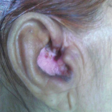 Histology Shows Infundibular Hyperplasia Follicular Plugging Download Scientific Diagram