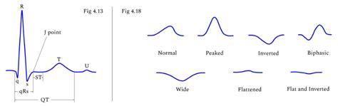 T Wave Skillstat