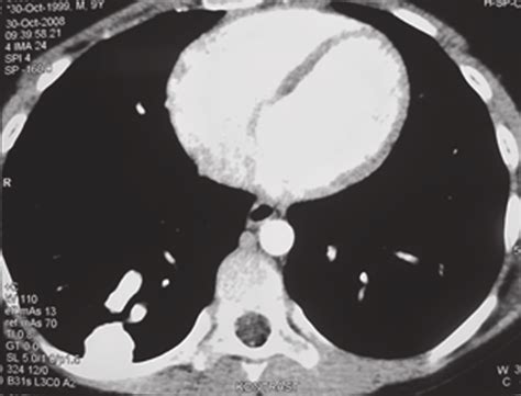A B Dense Contrasted Tubular And Nodular Enhancing Lesions Consistent Download Scientific