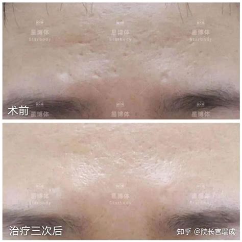 谁是姐姐的心选？一篇文章帮你解决三种痘坑问题 知乎