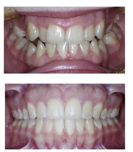 Ortho Occlusion And Malocclusion Flashcards Quizlet