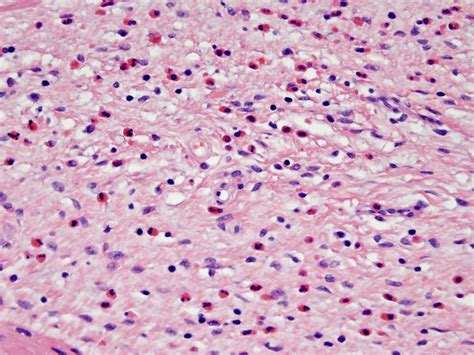 Pathology Outlines Inflammatory Fibroid Polyp