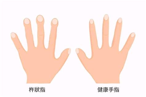何为杵状指 春雨医生
