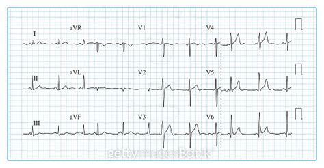 Heart Cardiogram Chart Vector Illustration Of Wave Form On Checked Ecg Graph Heart Rhythm