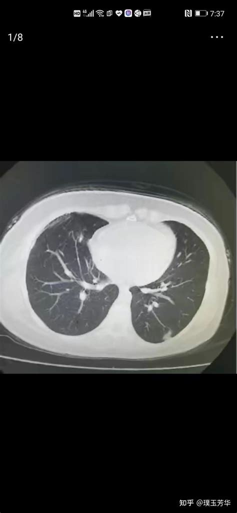 右肺磨玻璃结节肺叶切除后左肺又出现13mm肺结节要再做手术吗 知乎