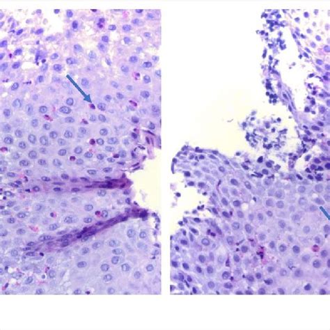 Polyp Located In Distal Esophagus Near Gastroesophageal Junction Prior Download Scientific