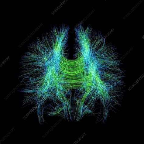 Brain Fibres D Diffusion Tensor Imaging DTI Magnetic Resonance Imaging MRI Scan Of Nerve