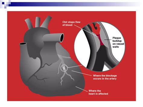 Myocardial Infarction PPT