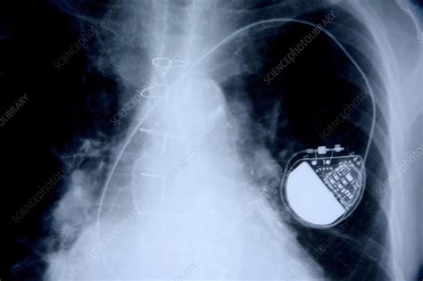 Pacemaker X Ray Stock Image C030 6841 Science Photo Library