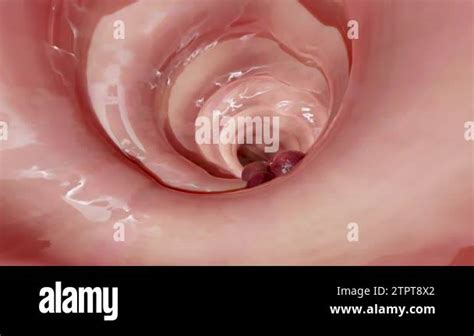Colorectal Cancer Malignant Tumor In Intestine Endoscope Inside