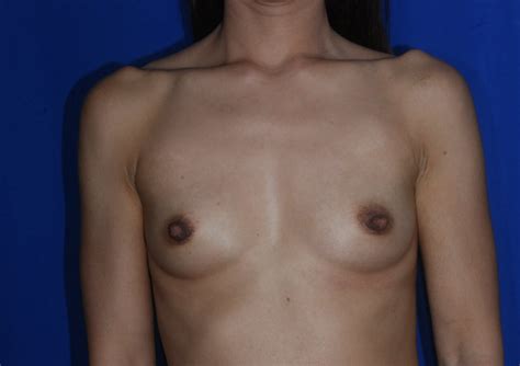 Procedure Page 106 Global Bibm