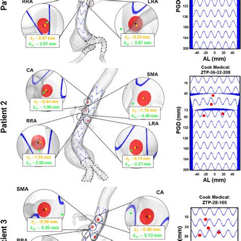 Mesh Parameterization Algorithm In Fenfit A A 3d Graft Mesh And
