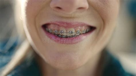 Young Blonde Woman Smiling Confident Showing Braces At Street Stock