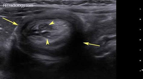 Rit Radiology Intussusception Ultrasound