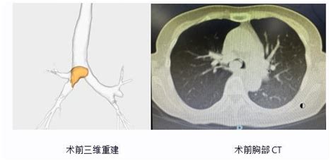 哈醫大腫瘤醫院胸外科應用達芬奇機器人輕松解決花甲老人“堵得慌”難題 新華網