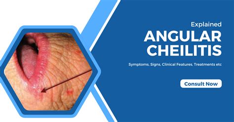 Angular Cheilitis Diagnosis Treatments Clinical Features And More