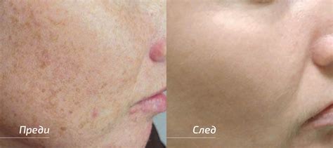 Лазерно третиране на пигментни петна Медицински център Кордис