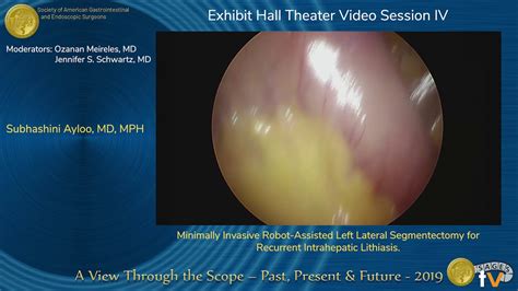 Minimally Invasive Robot Assisted Left Lateral Segmentectomy For